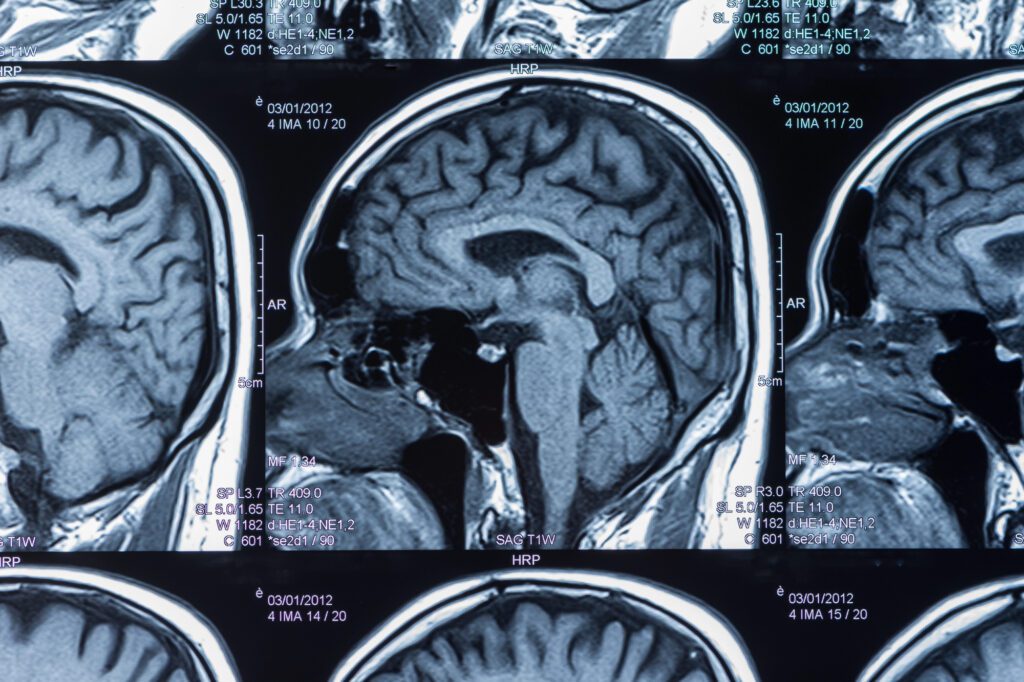 The Truth About Concussions and CTE: Insights from New Research - Dr ...